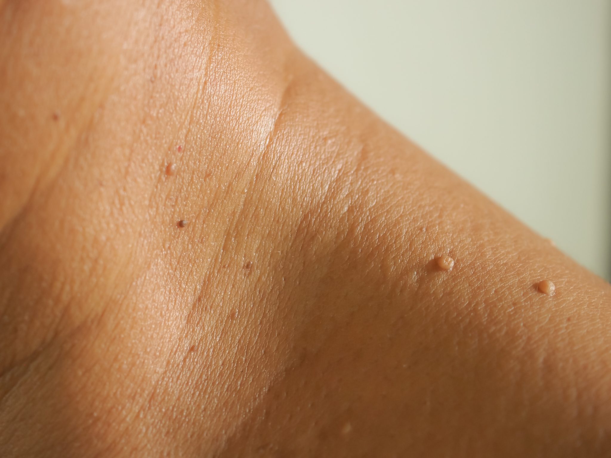 What Are Skin Tags? And Do I Need To Remove Them?